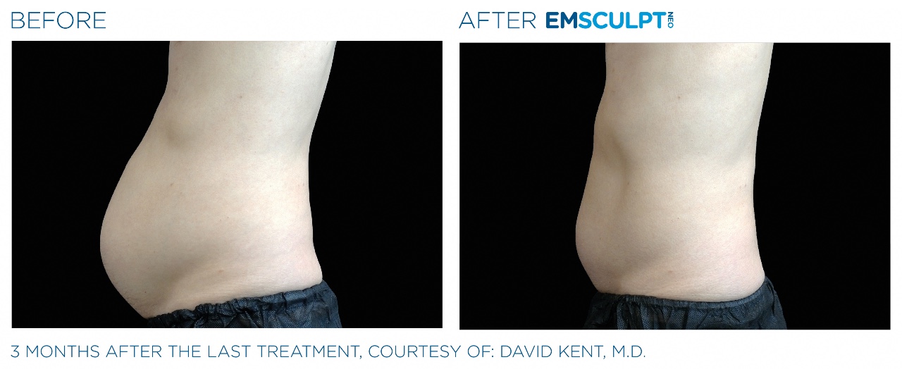EM SCULPT NEO – Salcedo Medical Center and Vein Institute – Promotions